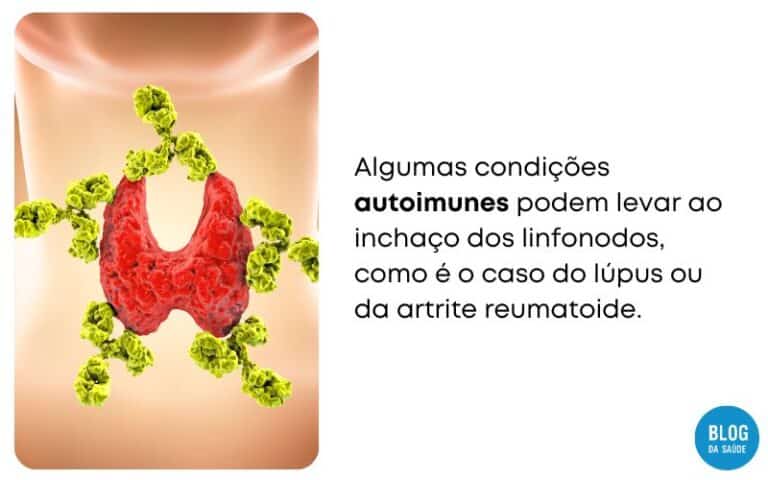 Caroço Dolorido No Pescoço - O Que Pode Ser? - Blog Da Saúde