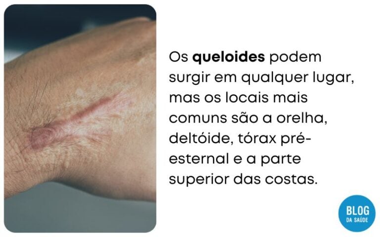 Como Evitar Queloides? - Blog Da Saúde