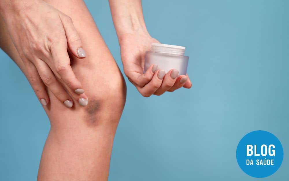 Flebon (Pycnogel) Para Melasma - Blog Da Saúde