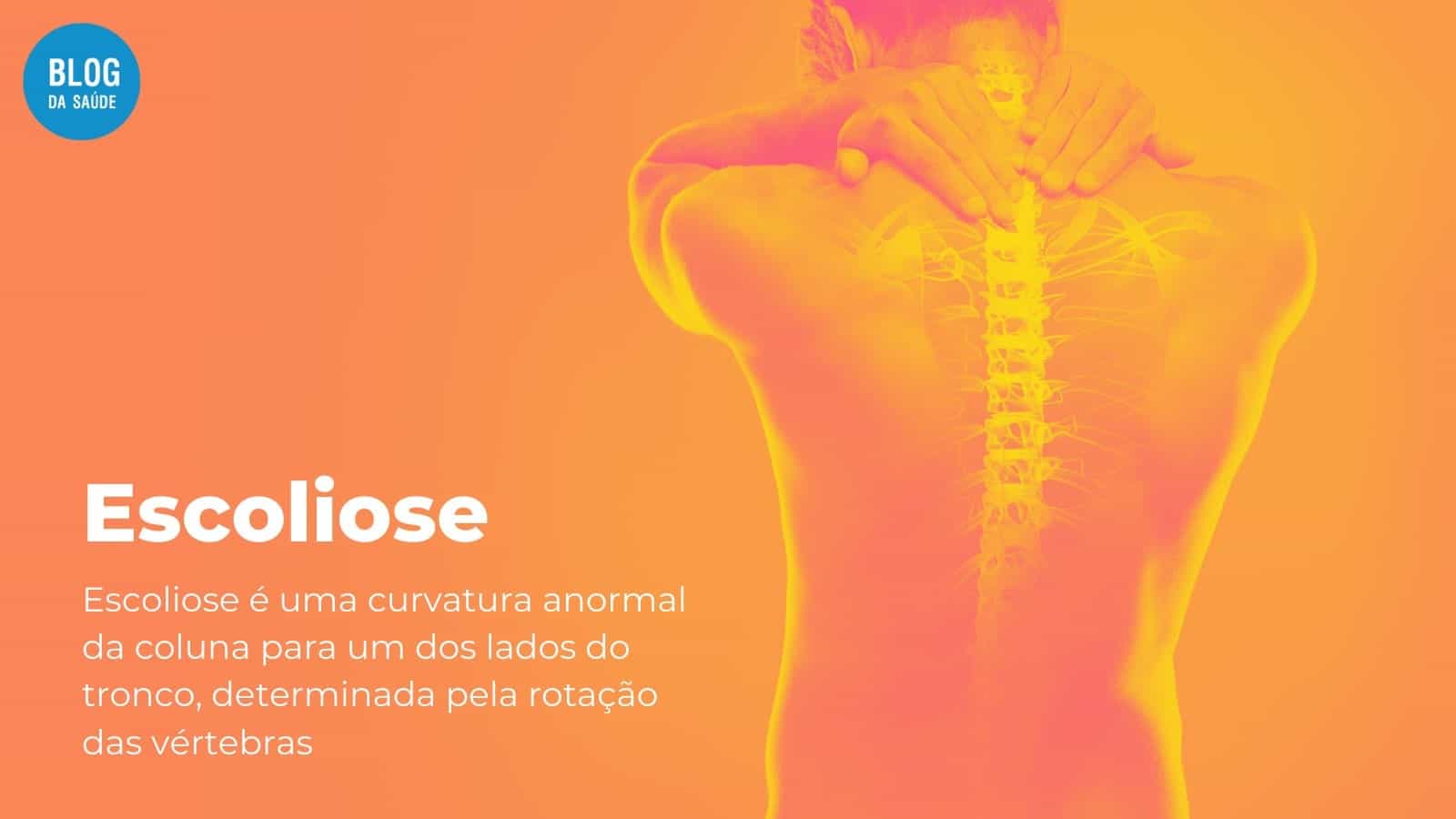 Escoliose - O Que é? Quando Me Preocupar? - Blog Da Saúde