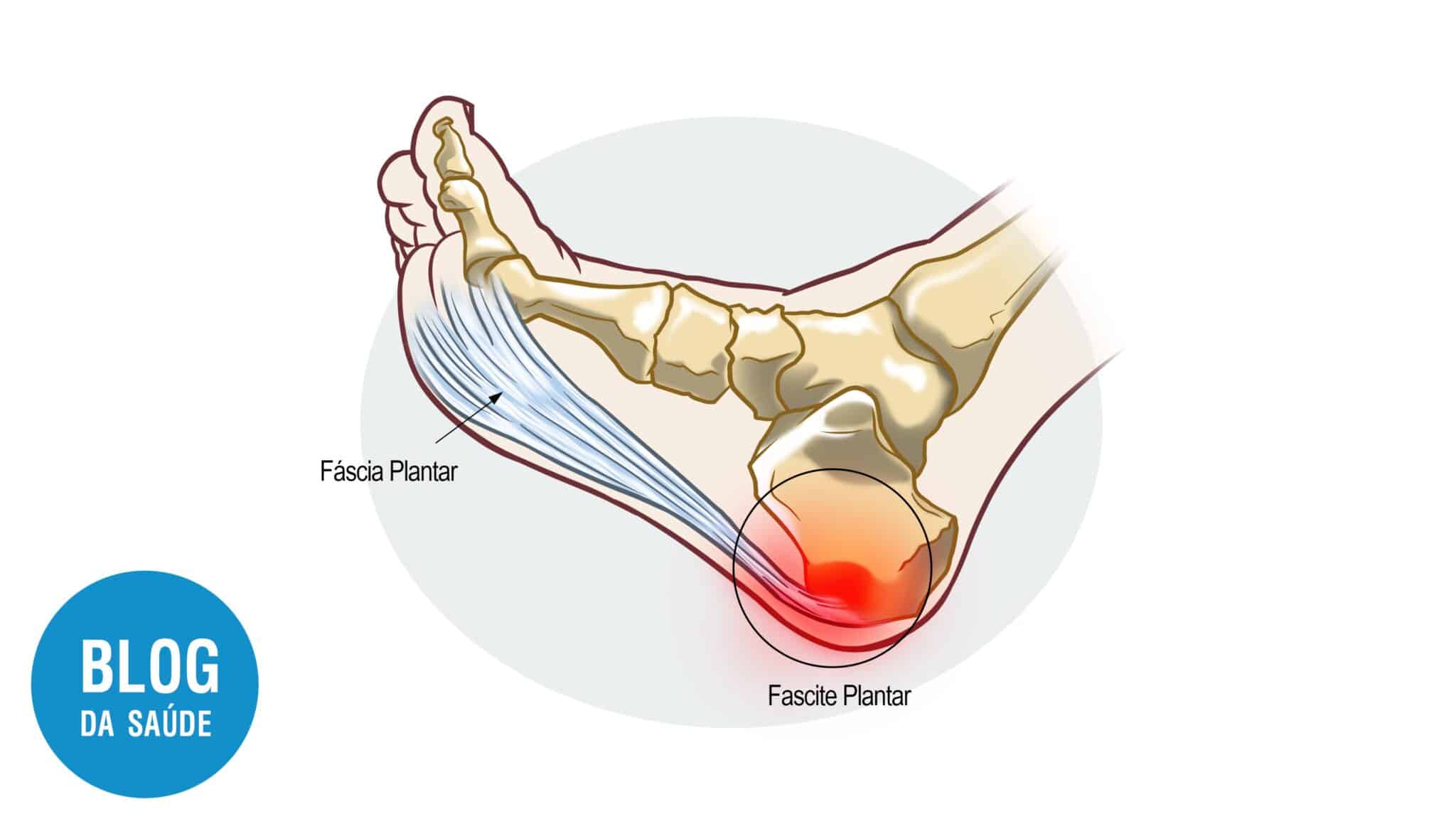 Fascite Plantar - O Que é? Causas, Sintomas E Tratamentos - Blog Da Saúde