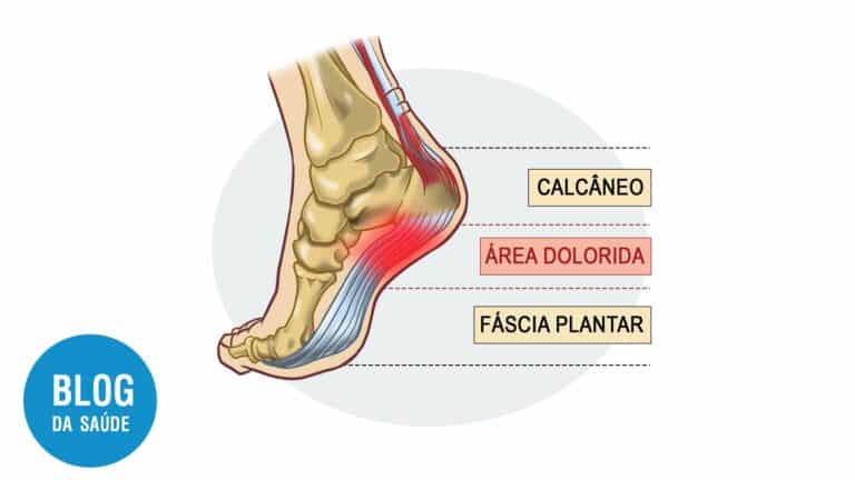 Fascite Plantar - O Que é? Causas, Sintomas E Tratamentos - Blog Da Saúde