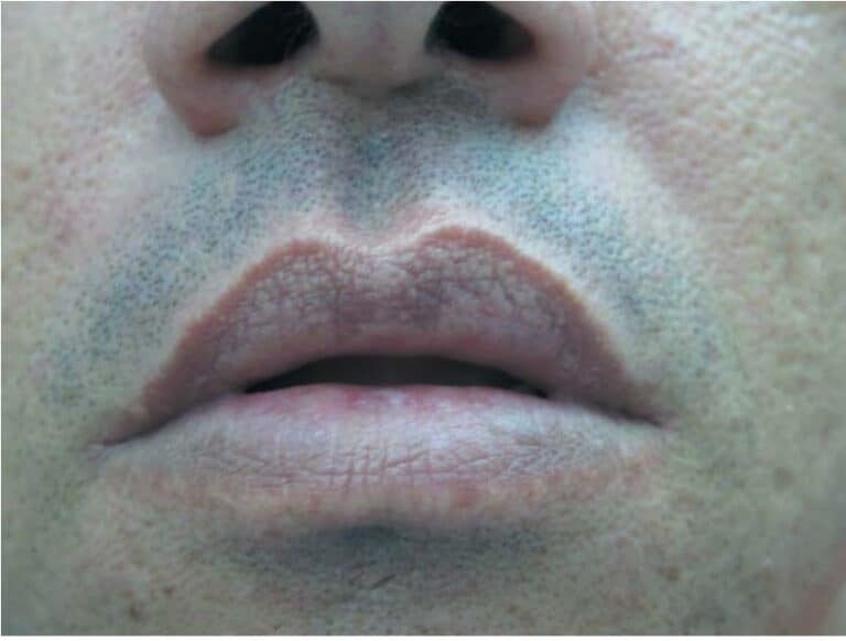 Grânulos De Fordyce - Blog Da Saúde