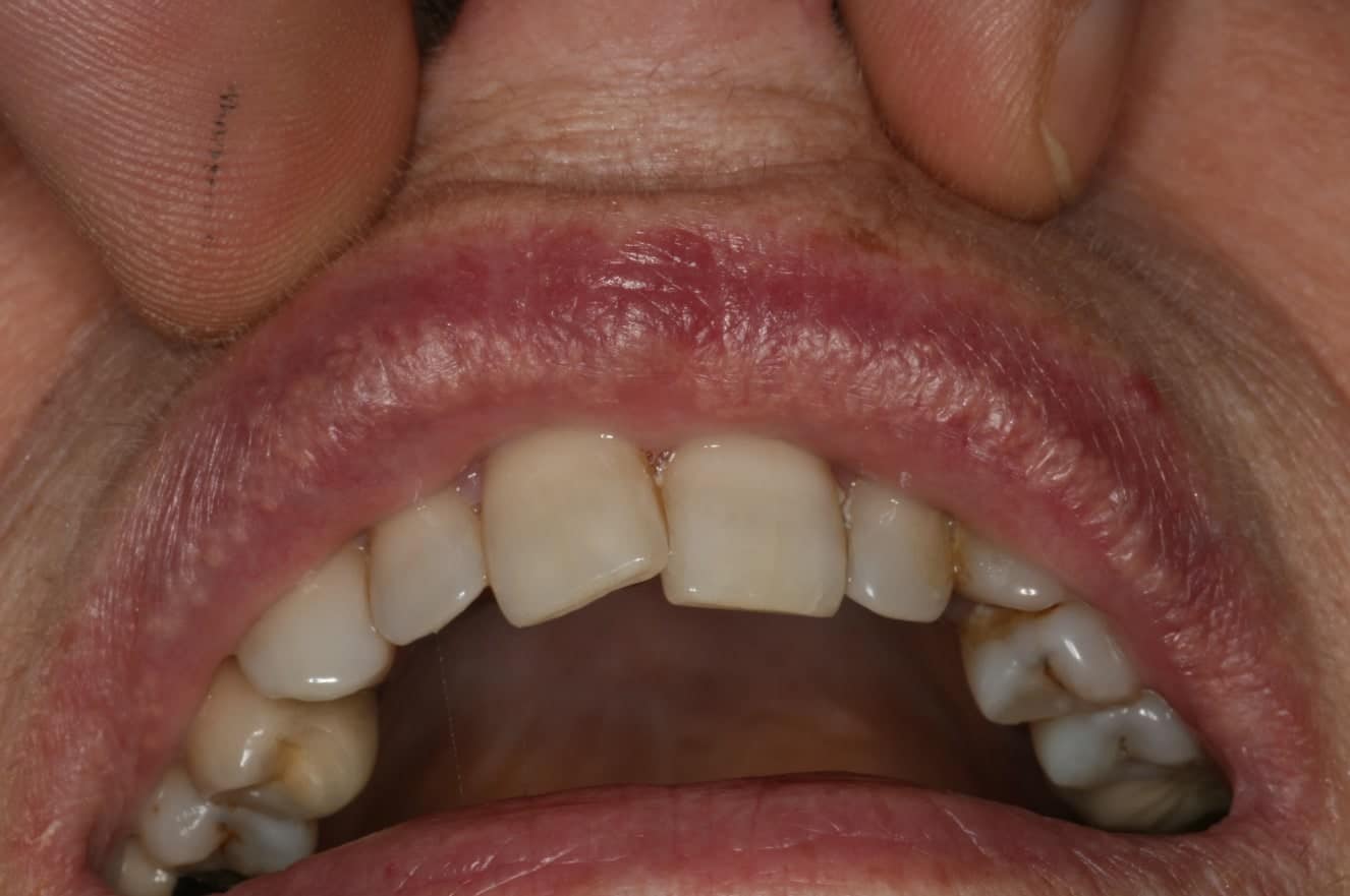 Grânulos De Fordyce - Blog Da Saúde