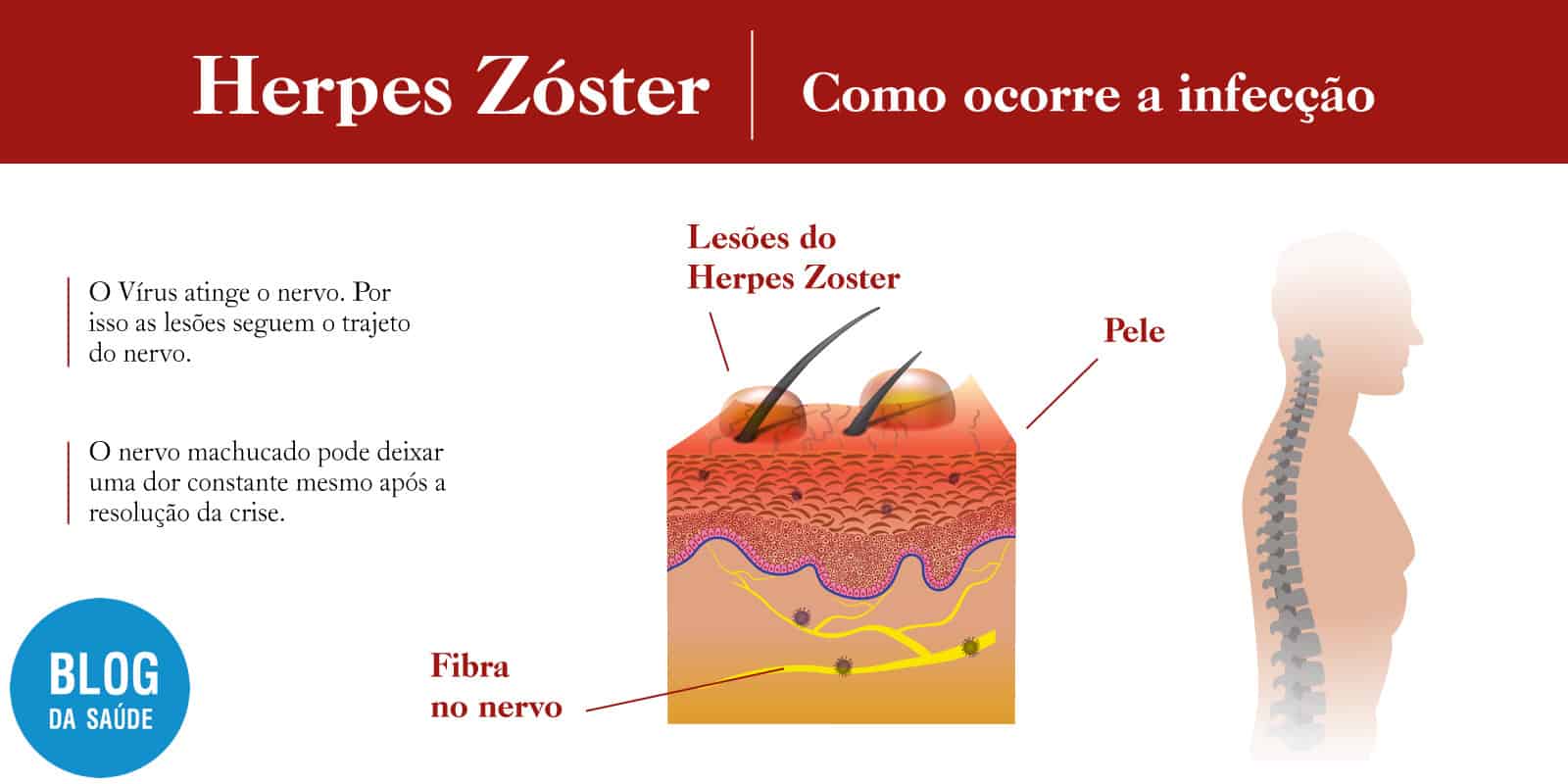 Causas Emocionais Da Herpes-zóster Tratamento - RETOEDU