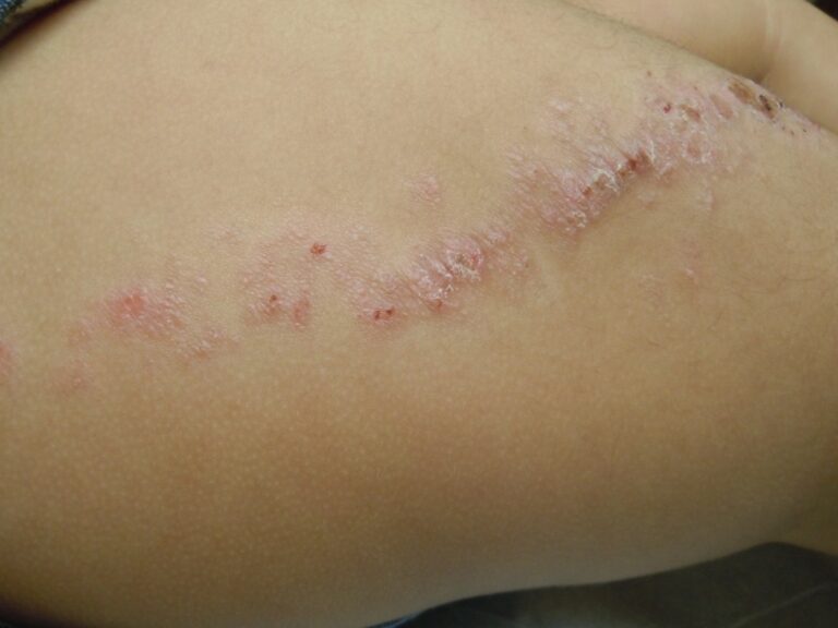 Líquen Estriado - O Que é? Causas, Sintomas E Tratamentos - Blog Da Saúde