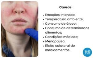 Rubor Na Face – Causas, Tratamento E Prevenção - Blog Da Saúde