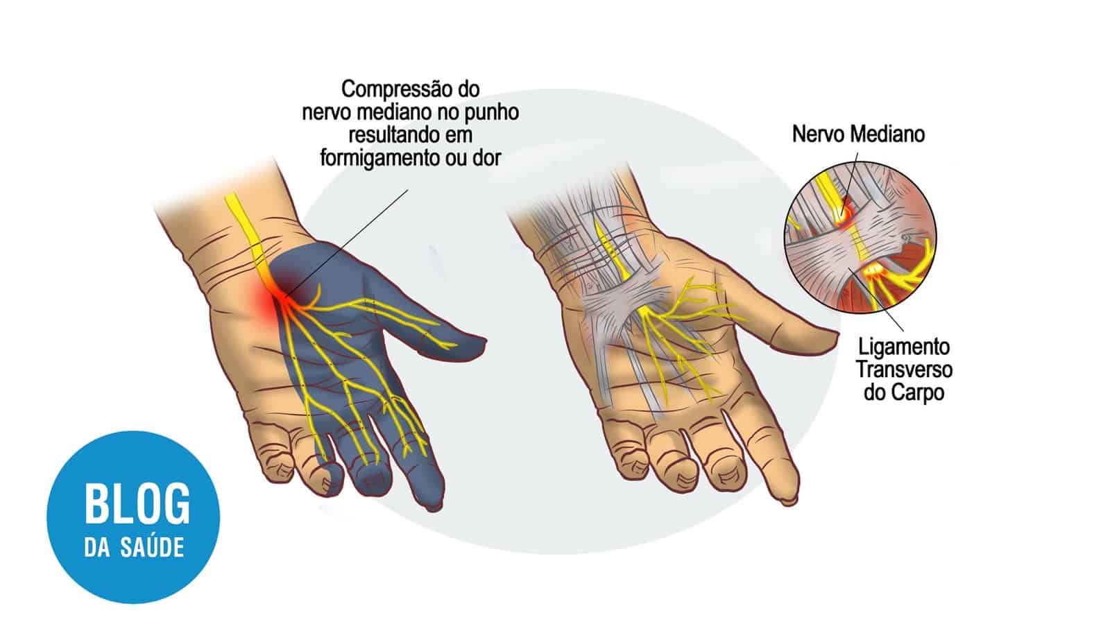 Síndrome Do Túnel Do Carpo Tem Cura? - Blog Da Saúde