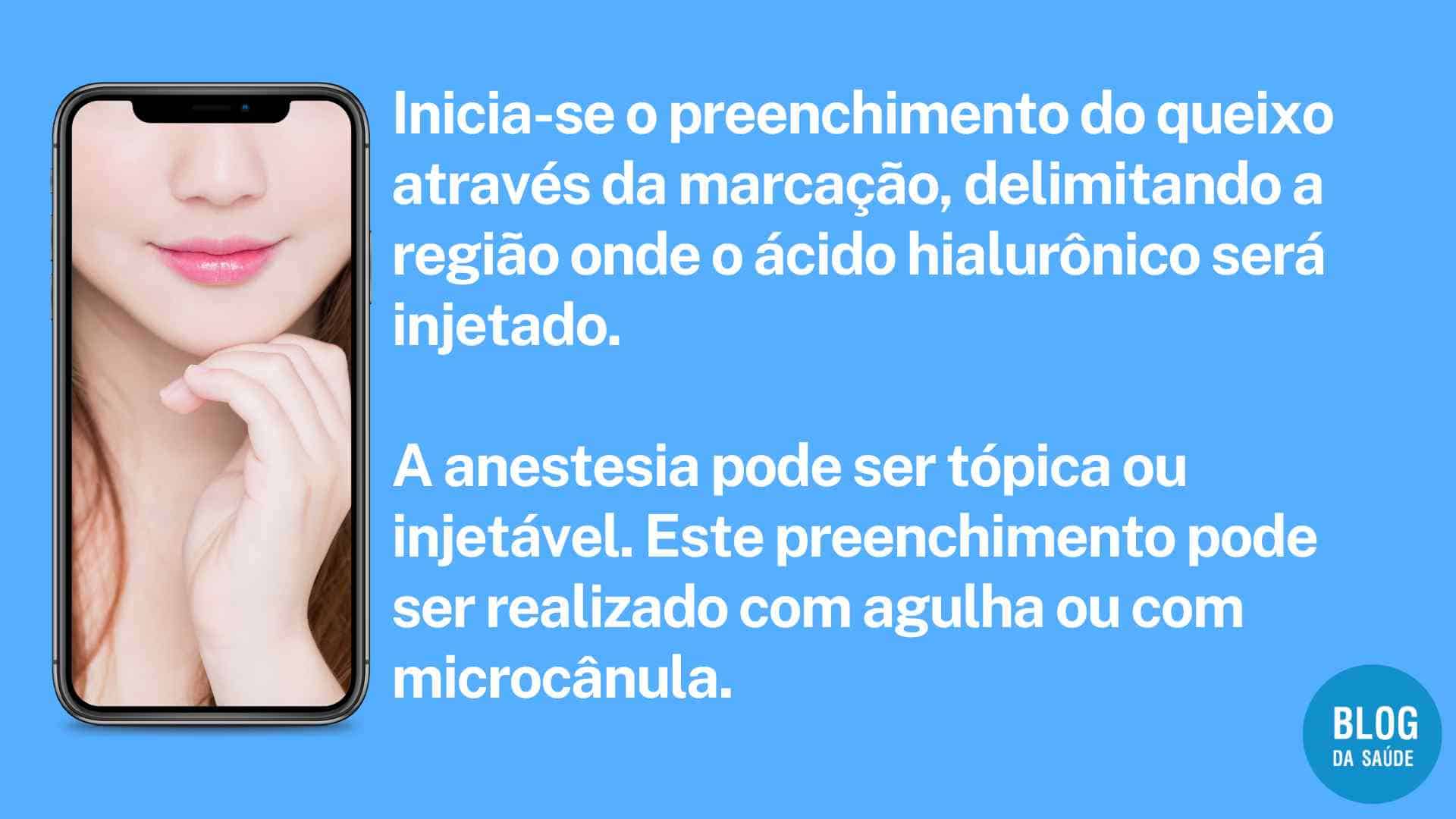Preenchimento De Queixo - Blog Da Saúde