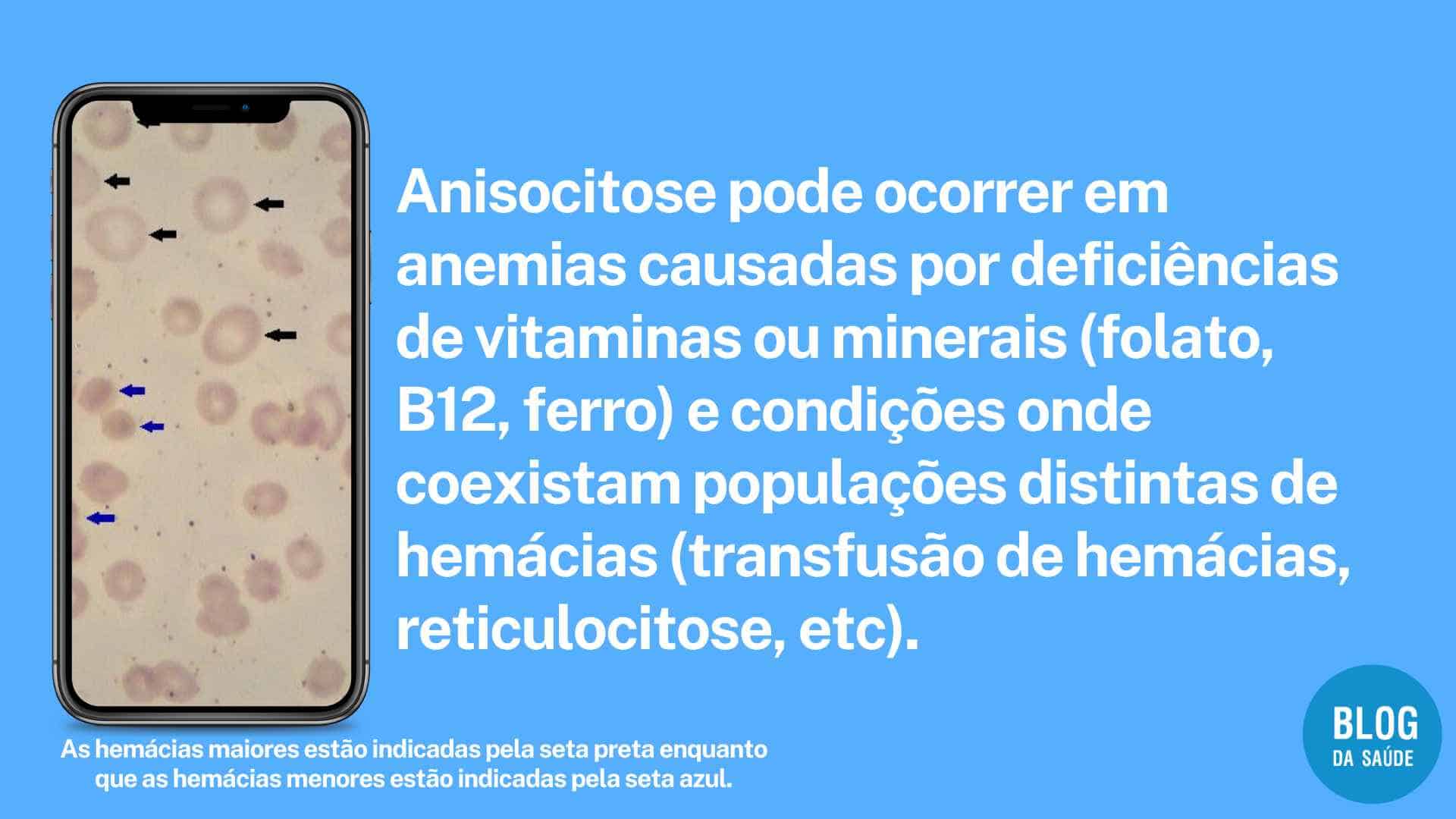 Anisocitose: O Que é, Como Funciona O Diagnóstico E O Que Fazer - Blog ...