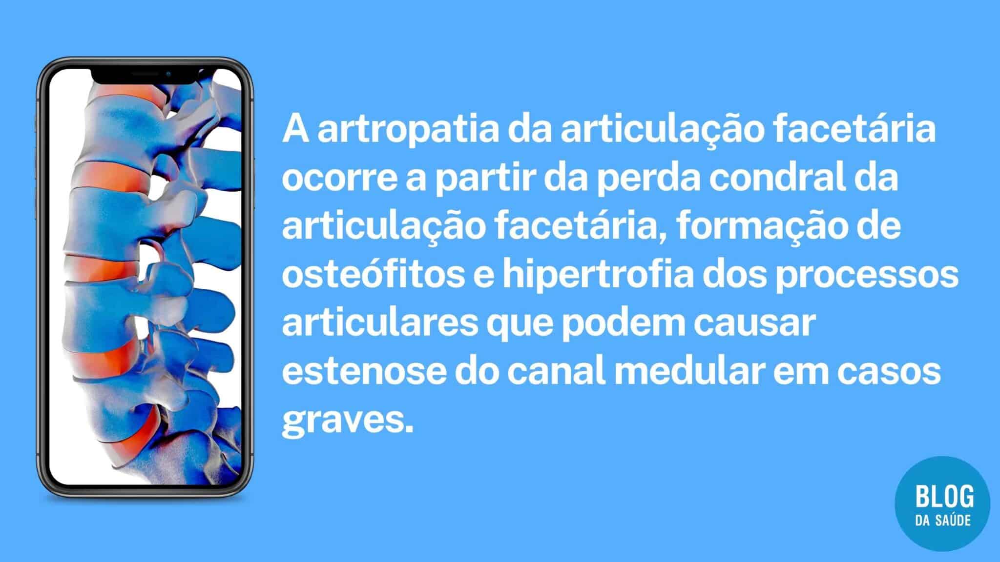Artrose Interfacetária: O Que é? E Como Tratar? - Blog Da Saúde