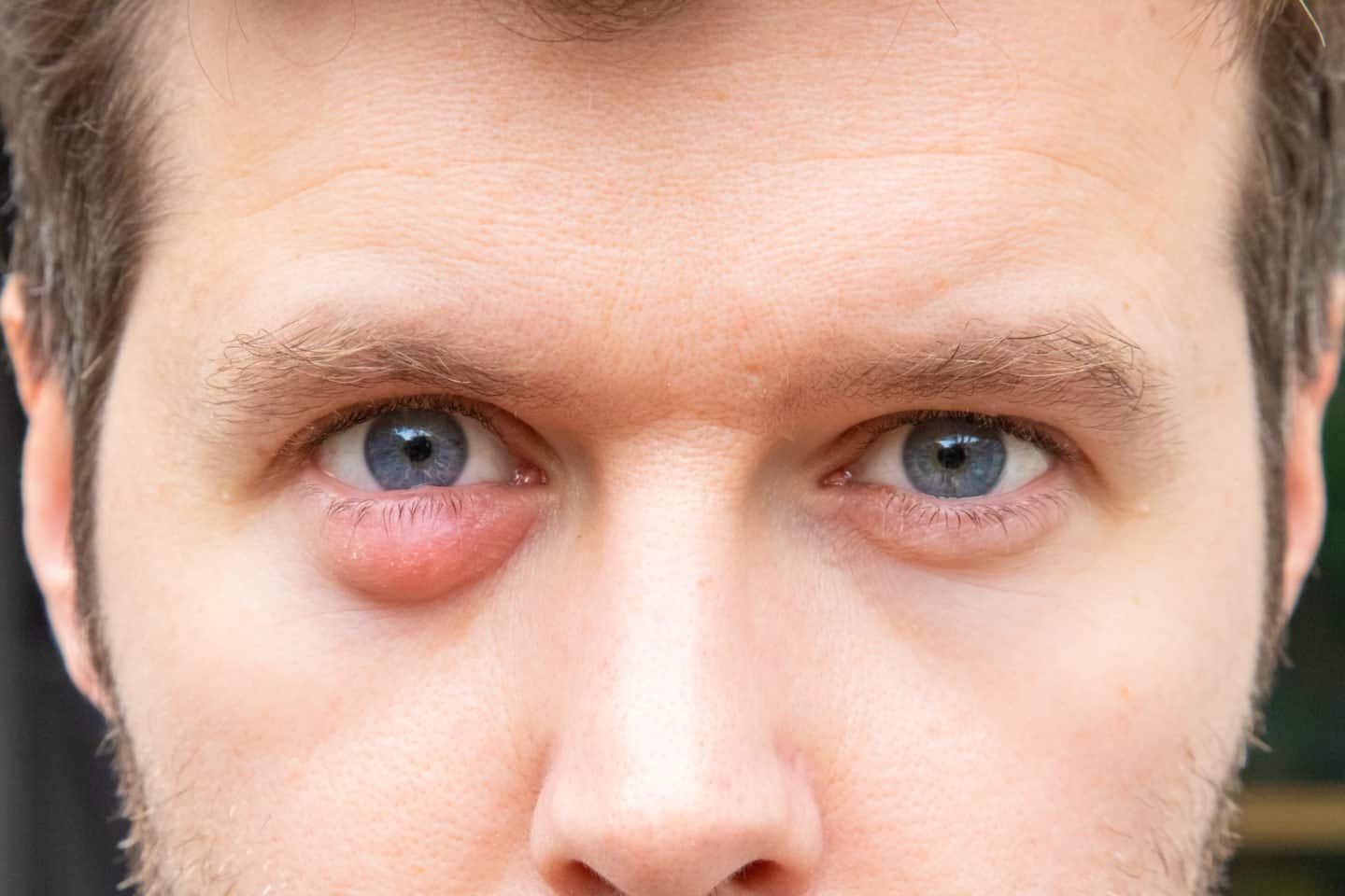 Calázio ("bolinha No Olho")- O Que é? Causas, Sintomas E Tratamentos - Blog Da Saúde