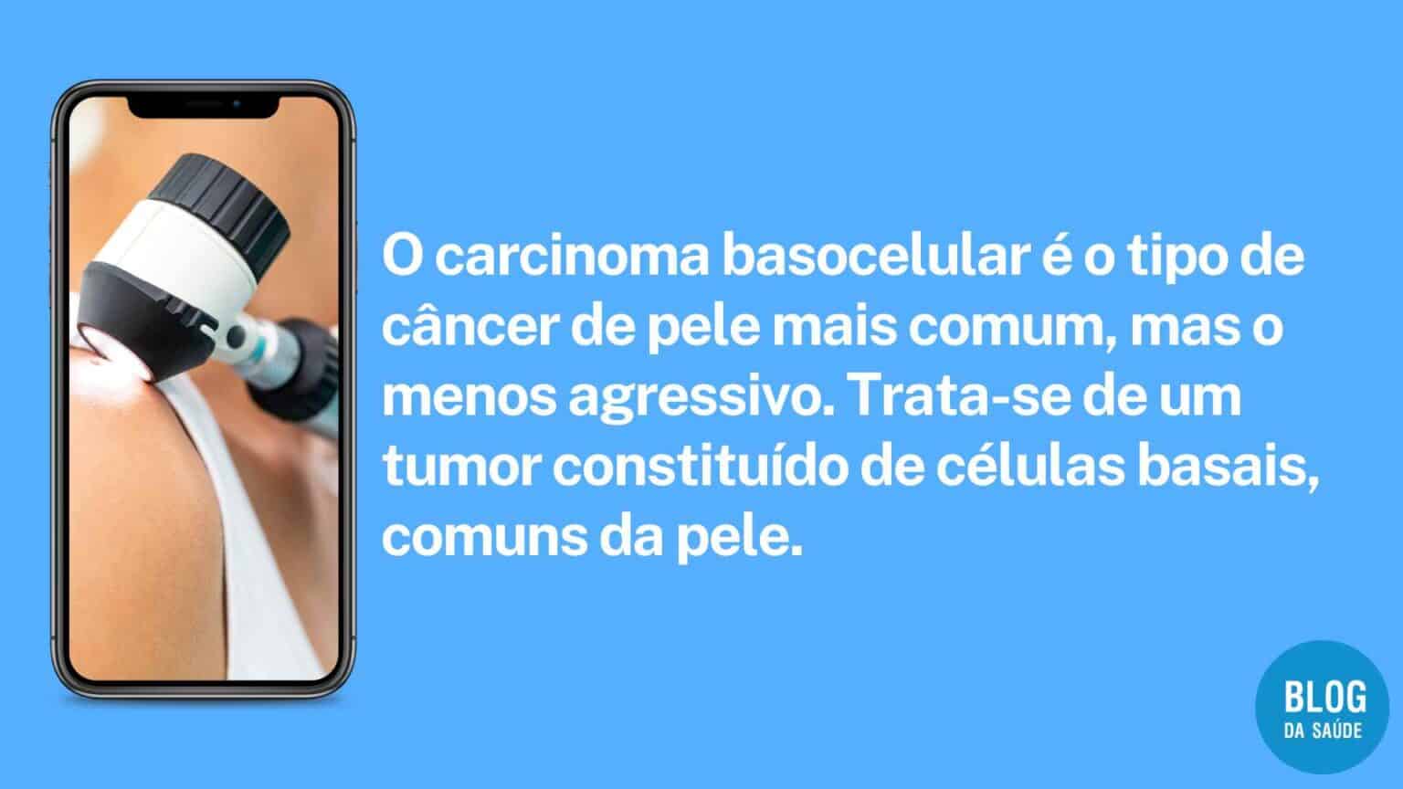Carcinoma Basocelular - Tipo Mais Comum De Câncer De Pele - Blog Da Saúde