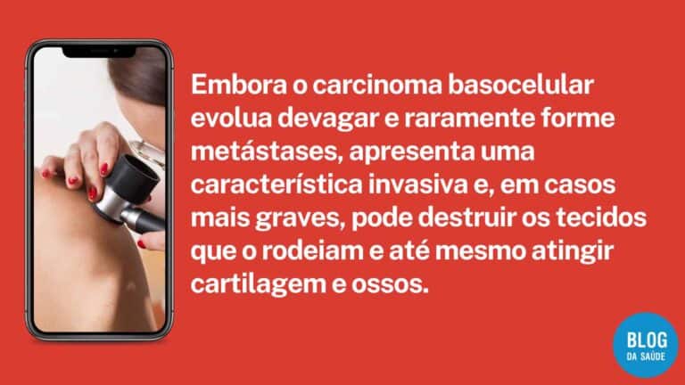 Carcinoma Basocelular - Tipo Mais Comum De Câncer De Pele - Blog Da Saúde