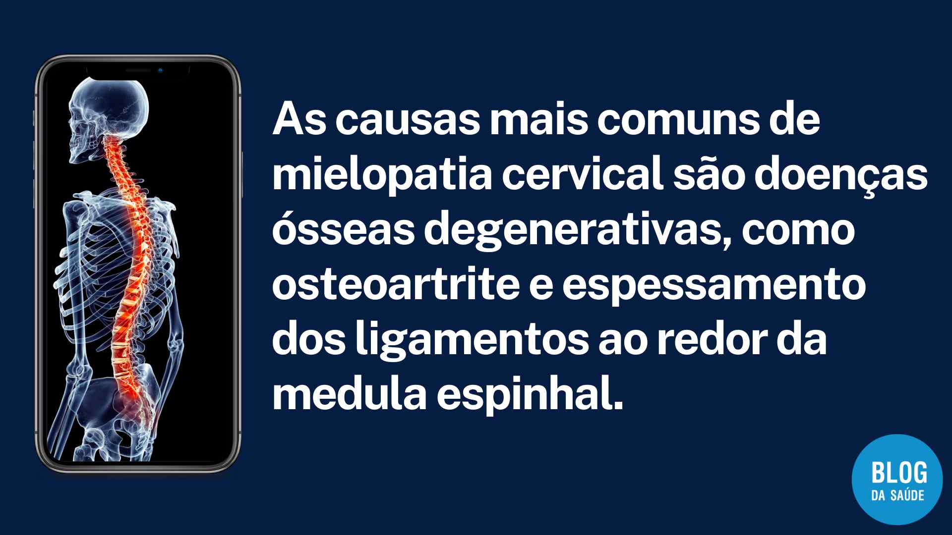 Mielopatia Cervical - Blog Da Saúde