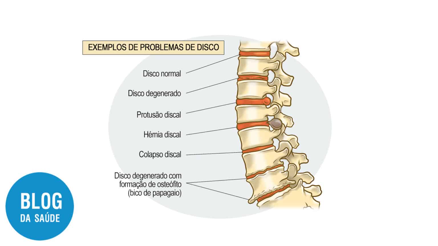 O Que É Hérnia De Disco Lombar Extrusa? - Blog Da Saúde
