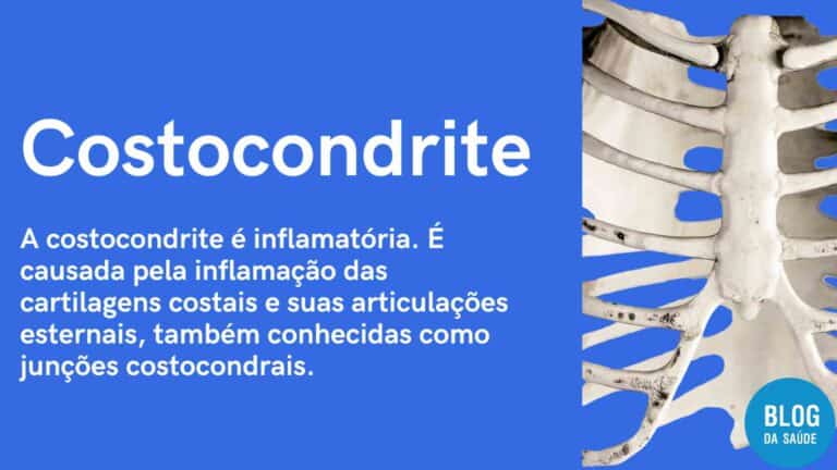 Costocondrite - O Que é? Causas, Sintomas E Tratamentos - Blog Da Saúde