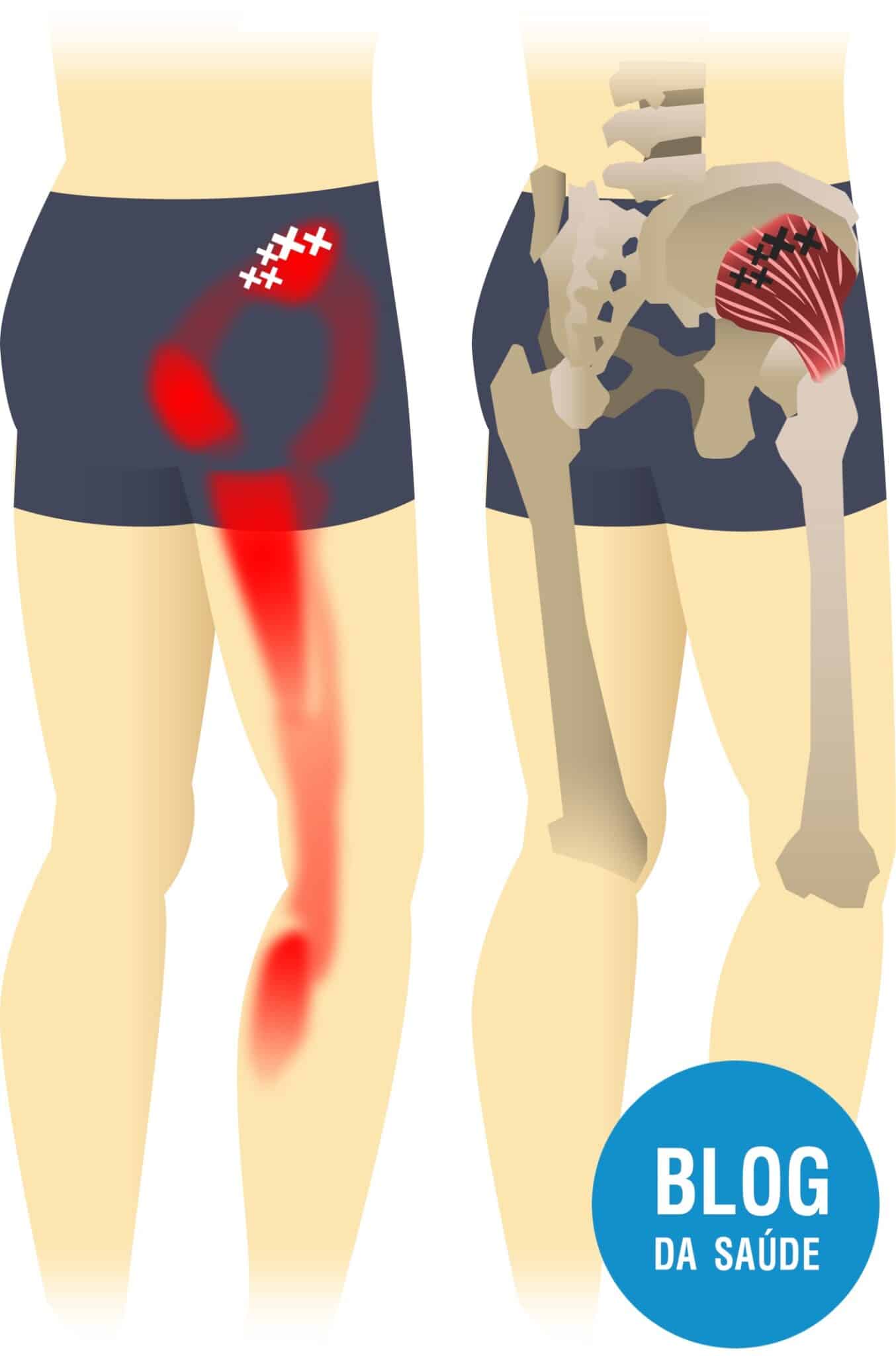 Síndrome Dolorosa Miofascial - O Que é, Causas, Sintomas E Tratamentos ...