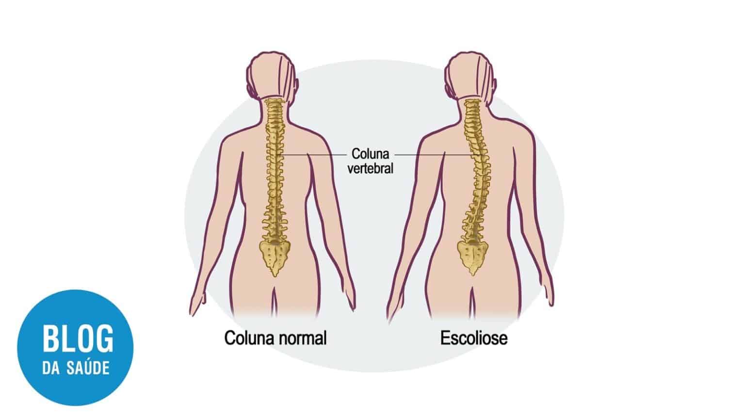 Escoliose: o que é, como identificar, sintomas e tratamento – PZGI