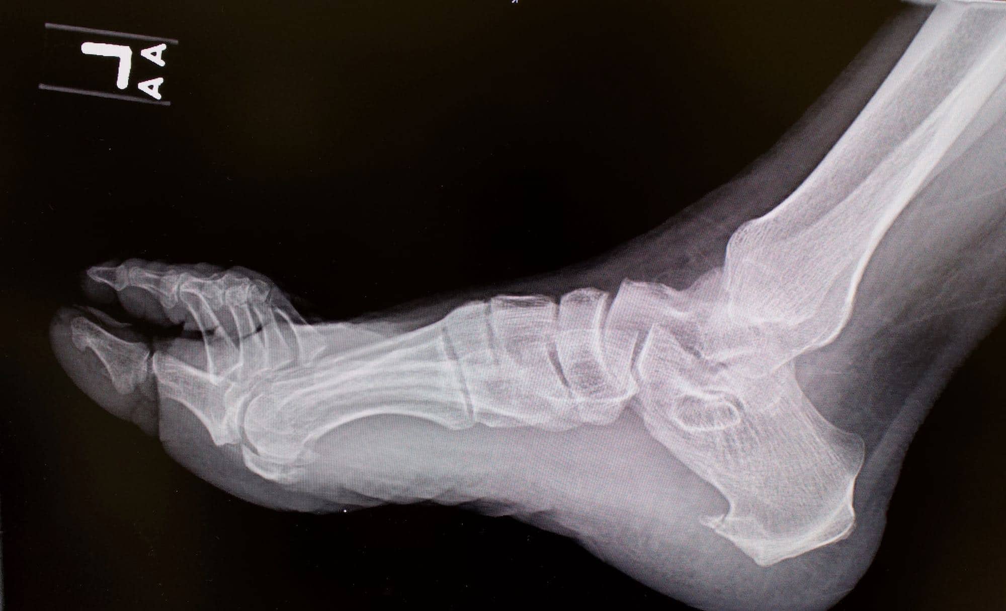 Esporão De Galo - Blog Da Saúde