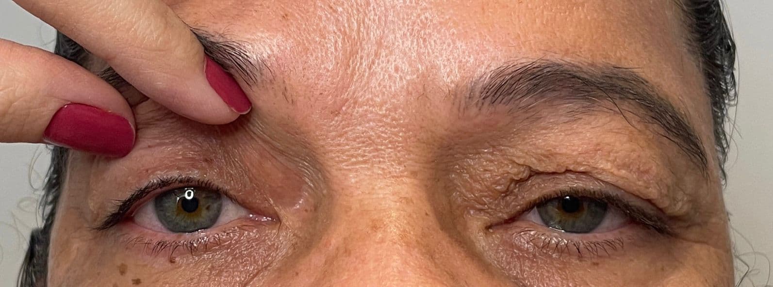 Blefaroplastia - Cirurgia Das Pálpebras - Aprenda Mais - Blog Da Saúde