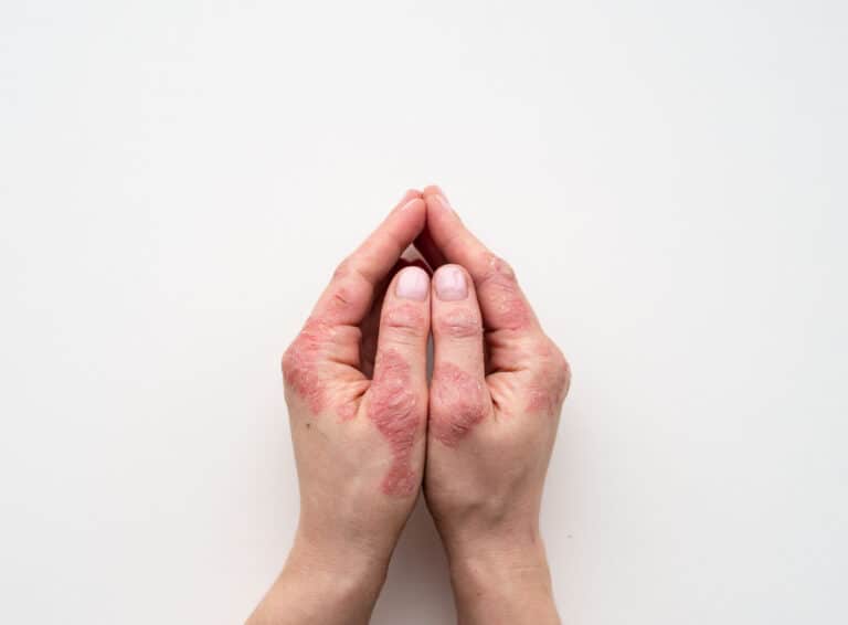 Formigamento Nas Mãos: O Que Pode Ser? - Blog Da Saúde