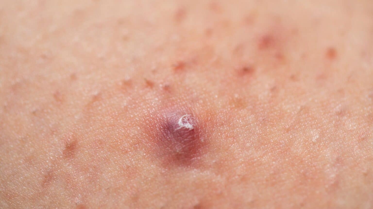 Tratamento Para Foliculite: Saiba Como Funciona - Blog Da Saúde