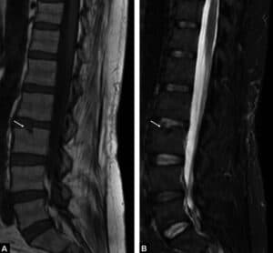 Nódulo De Schmorl - Blog Da Saúde