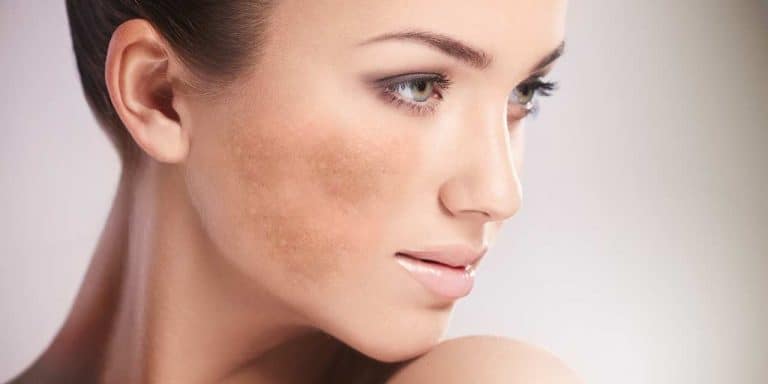 Melasma - O Que É? Causas, Sintomas E Diagnóstico - Blog Da Saúde