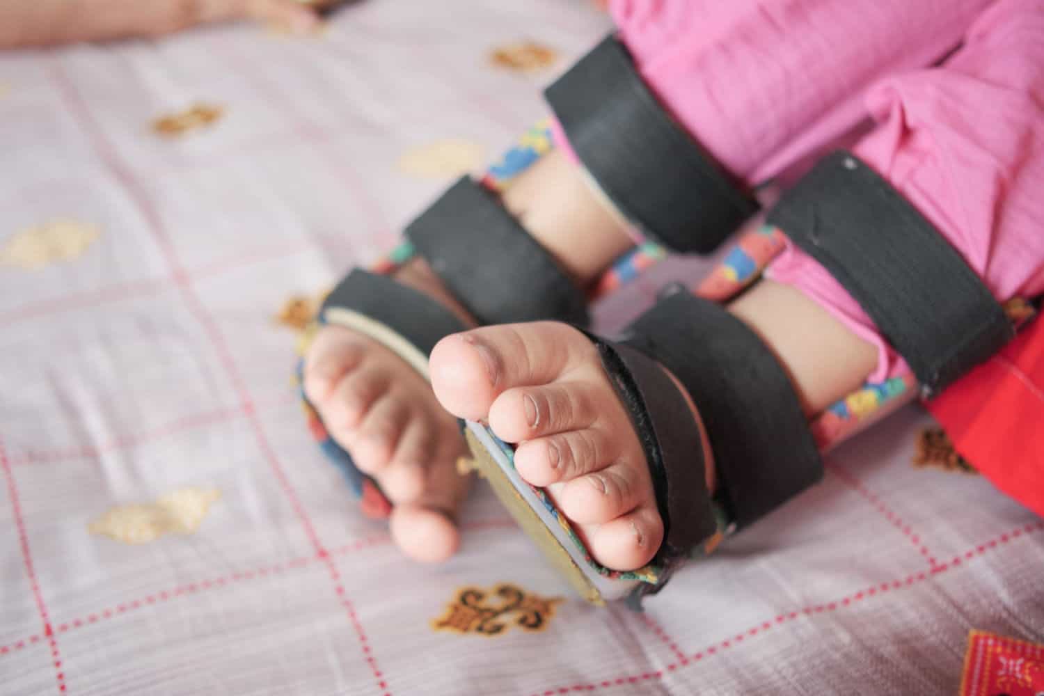 Órtese Dennis Brown - Órtese De Abdução - Blog Da Saúde