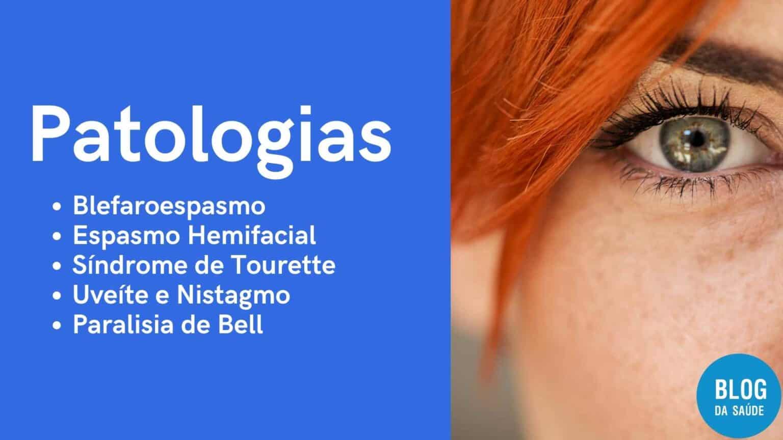 Pálpebra Tremendo (Mioquimia Facial Ou Blefaroespasmo): Entenda As ...