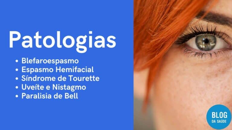 Pálpebra Tremendo (Mioquimia Facial Ou Blefaroespasmo): Entenda As ...