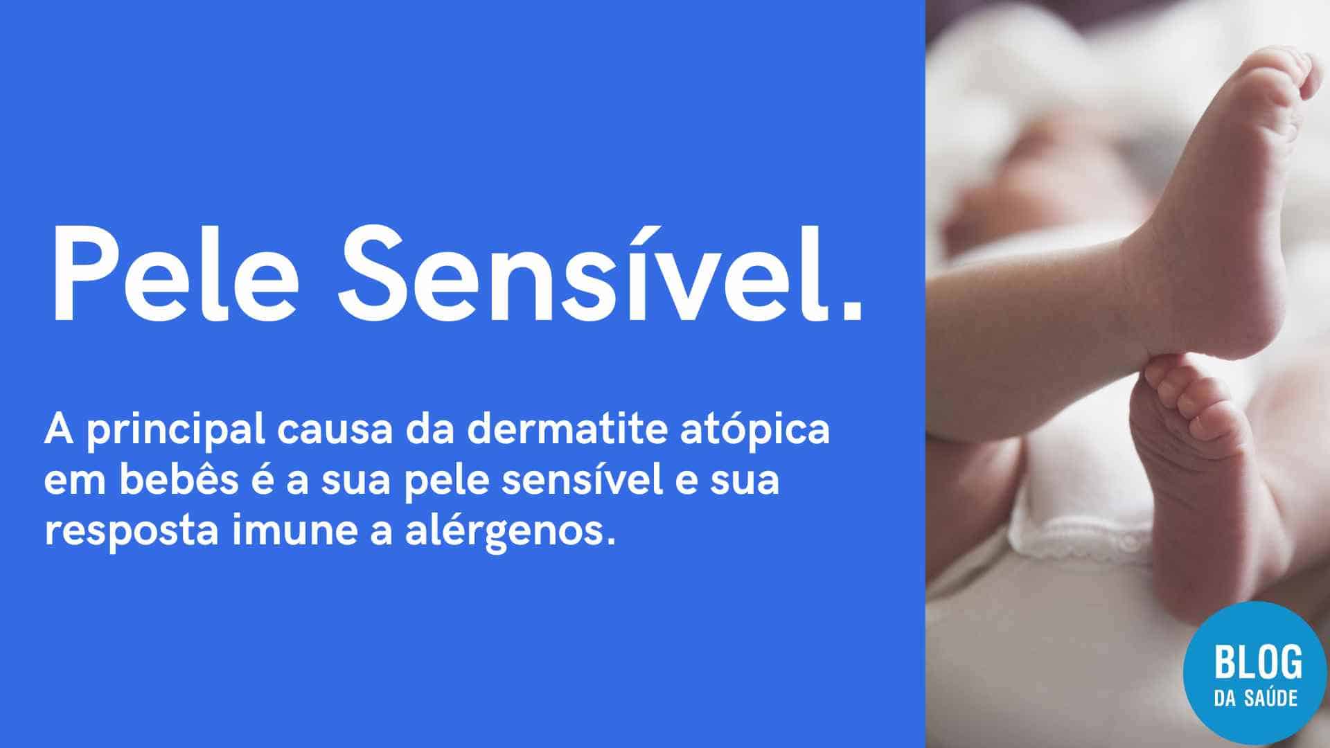 Dermatite Em Bebês - Blog Da Saúde