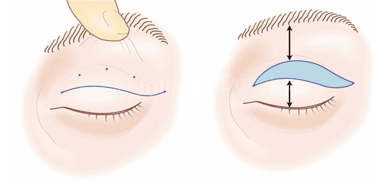 Ptose Palpebral Pós Botox: Por Que Acontece? - Blog Da Saúde