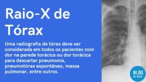 Costocondrite - O Que é? Causas, Sintomas E Tratamentos - Blog Da Saúde