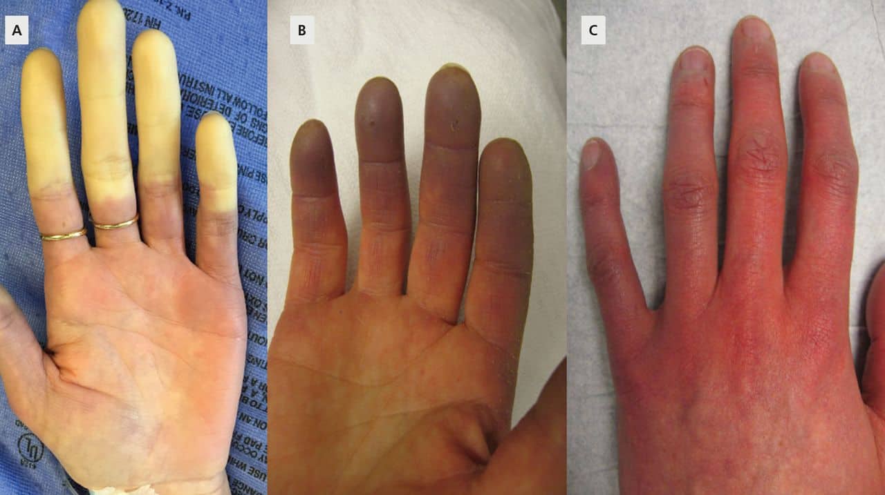 Síndrome De Raynaud (Fenômeno De Raynaud) - O Que É? Sintomas E ...