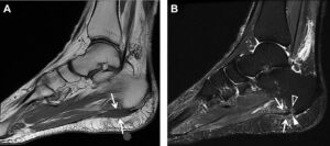 Fascite Plantar - O Que é? Causas, Sintomas E Tratamentos - Blog Da Saúde