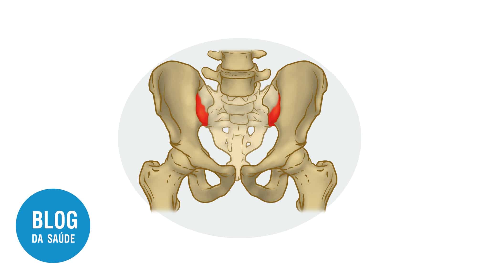 Articulação Sacroilíaca - Sacroileíte - Blog Da Saúde