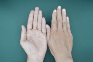 Síndrome De Raynaud (Fenômeno De Raynaud) - O Que É? Sintomas E ...