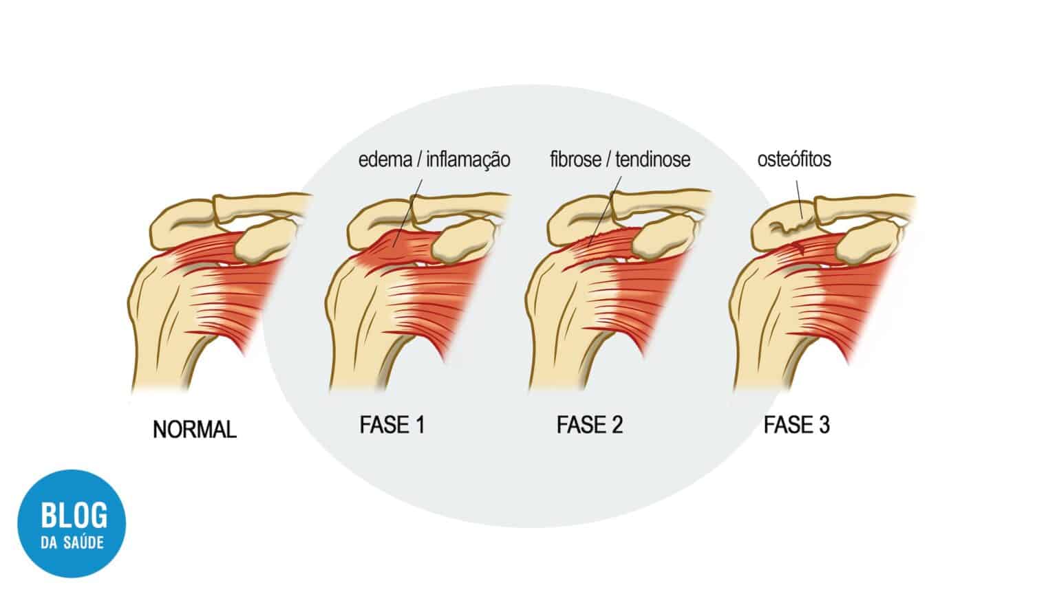 Bursite: O Que é? Sintomas, Causas E Tratamentos - Blog Da Saúde