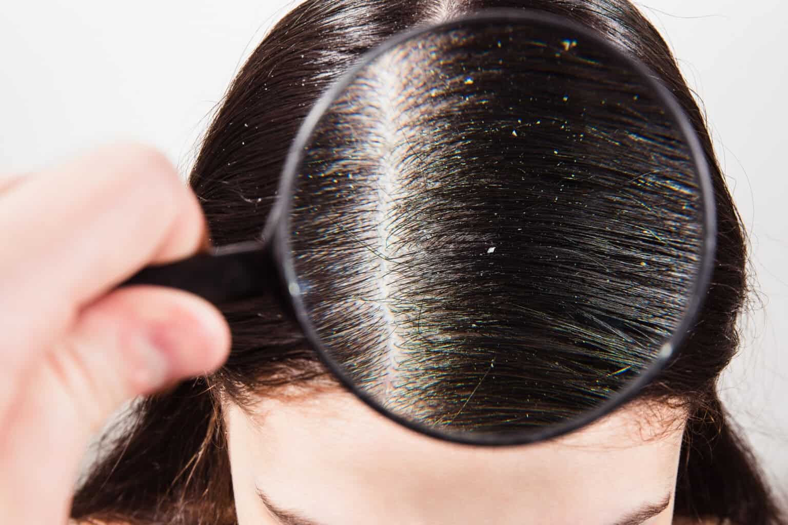 Mesoterapia Capilar: Saiba Como Tratar A Queda De Cabelo! - Blog Da Saúde