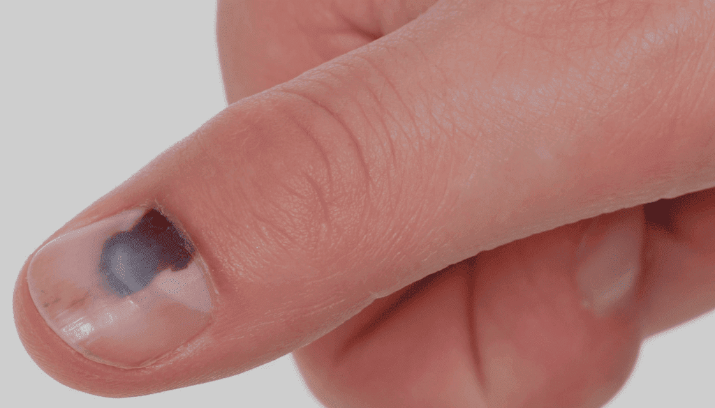 Flebon (Pycnogel) Para Melasma - Blog Da Saúde