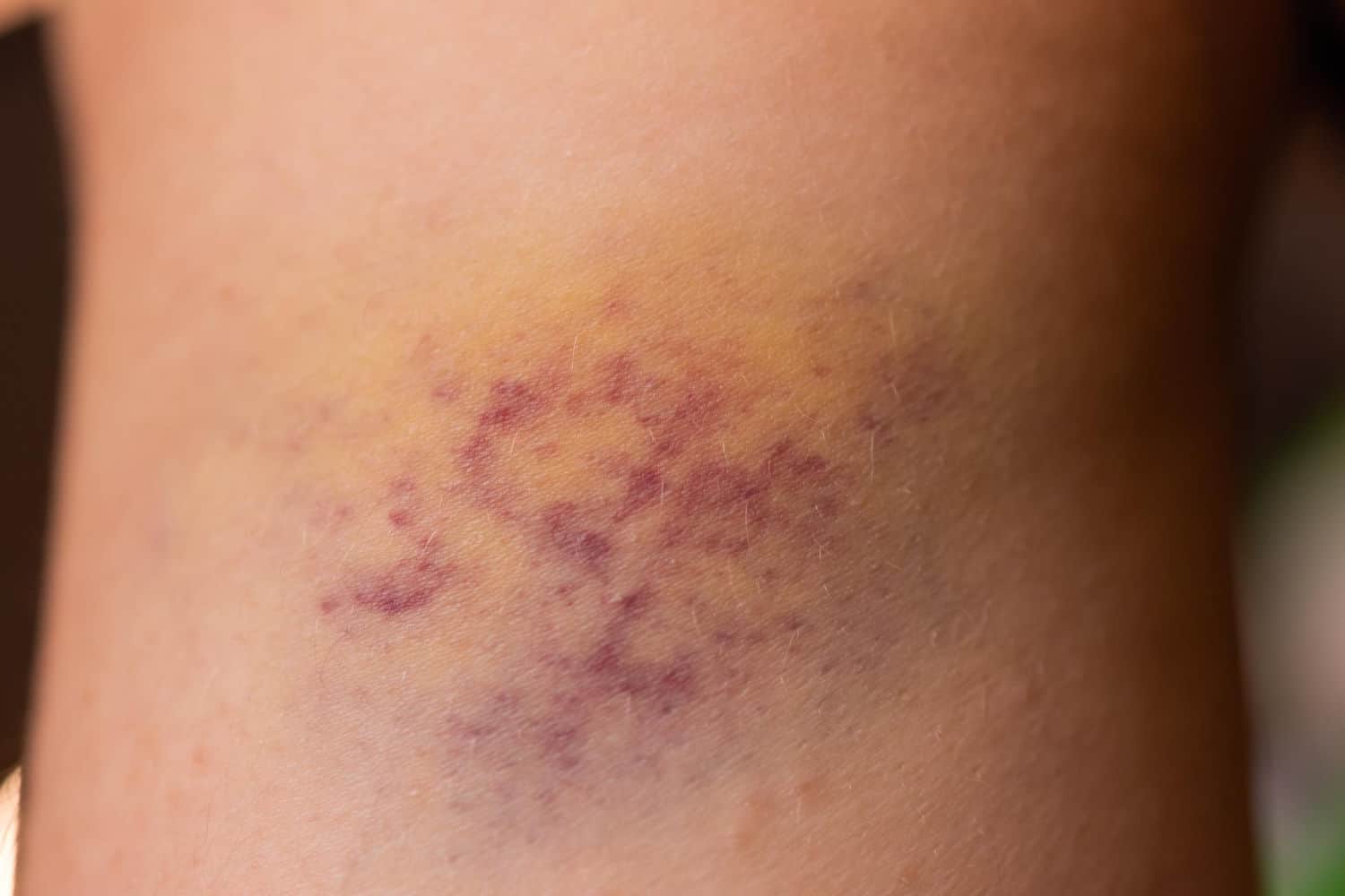 Vasinhos Na Perna - O Que Pode Ser? Causas, Sintomas E Tratamentos ...